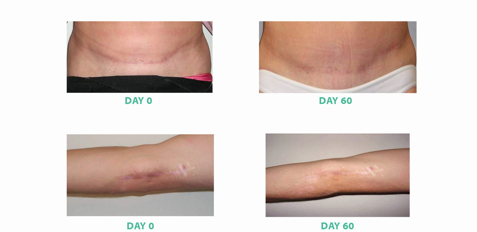Know the clinical evidence, Before & after with SODERMIX® Cream – LSI ...