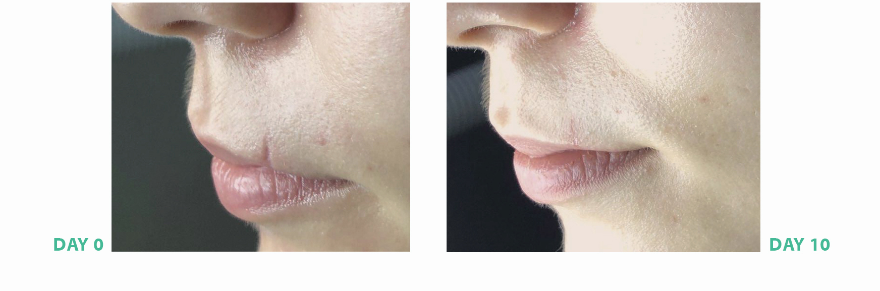 Know the clinical evidence, Before & after with SODERMIX® Cream – LSI ...