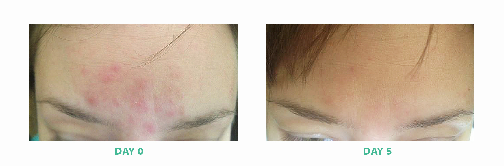 Know the clinical evidence, Before & after with SODERMIX® Cream – LSI ...