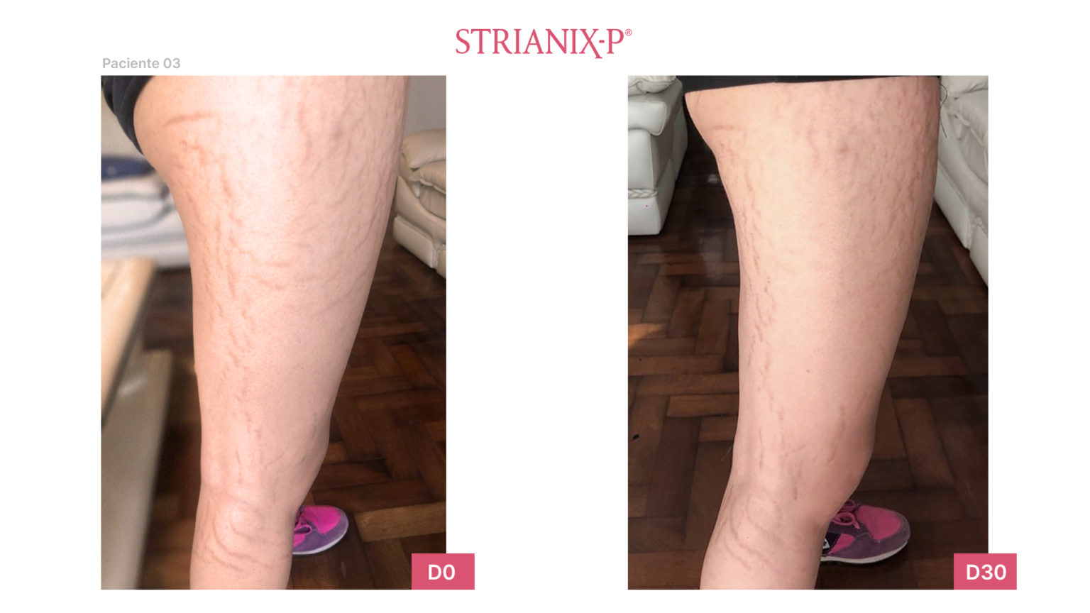 Introducing a novel management of stretch marks, STRIANIX-P & STRIANIX ...