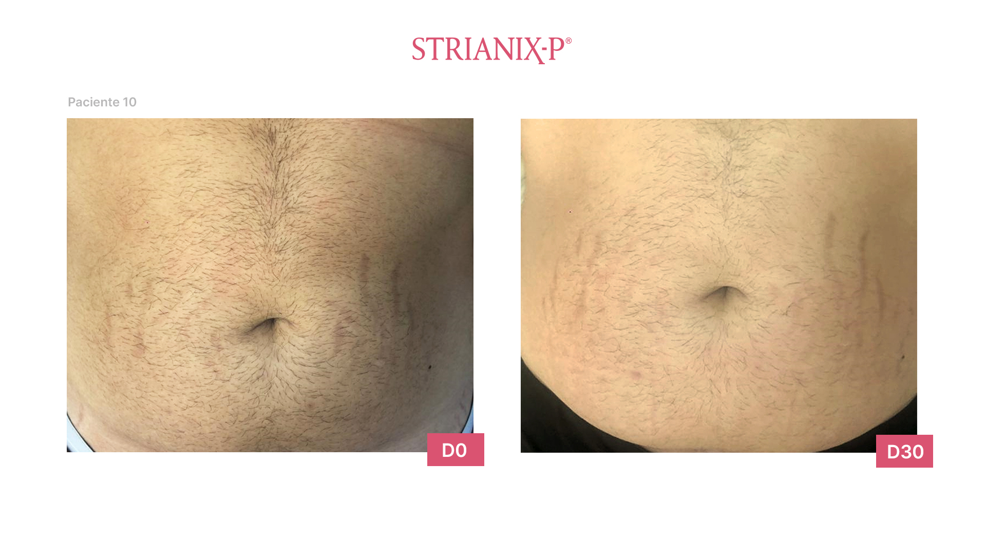 Introducing a novel management of stretch marks, STRIANIX-P & STRIANIX ...