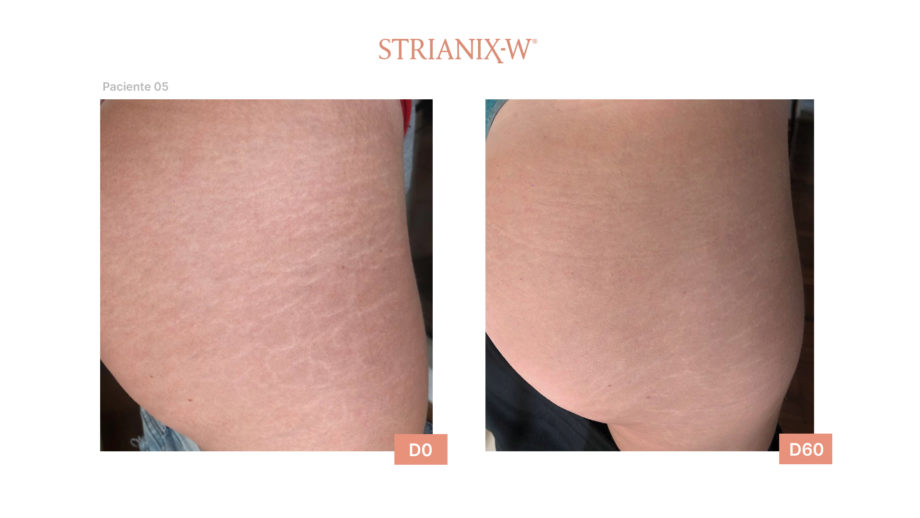 Introducing a novel management of stretch marks, STRIANIX-P & STRIANIX ...