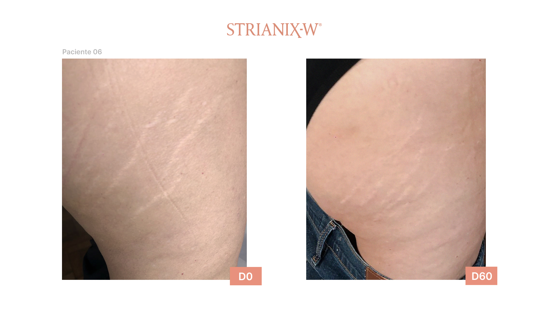 Introducing a novel management of stretch marks, STRIANIX-P & STRIANIX ...