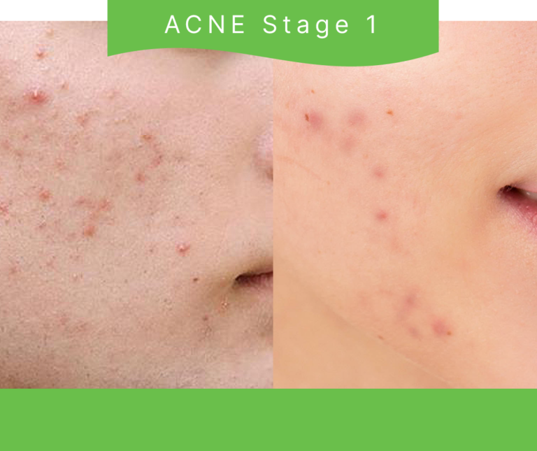 AKNIX® is an incredible complete line for all stages of acne. – LSI ...