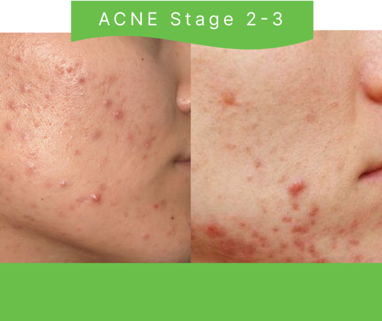 AKNIX® is an incredible complete line for all stages of acne. – LSI ...